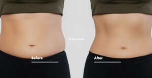 VA Body Sculpt - Electromagnetic technology – HIFEM